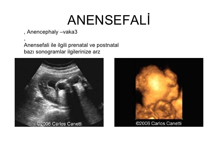 FETAL NÖROSONOGRAFİ
