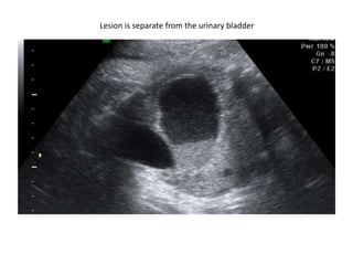 Fetal ovarian dermoid. Dr Shanti Shetty. Ultrafest 2014 | PPTX