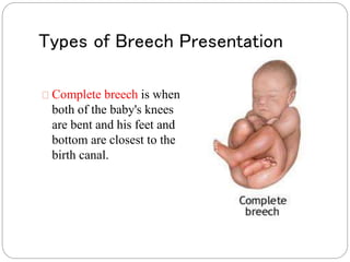 Fetal Presentation | PPTX