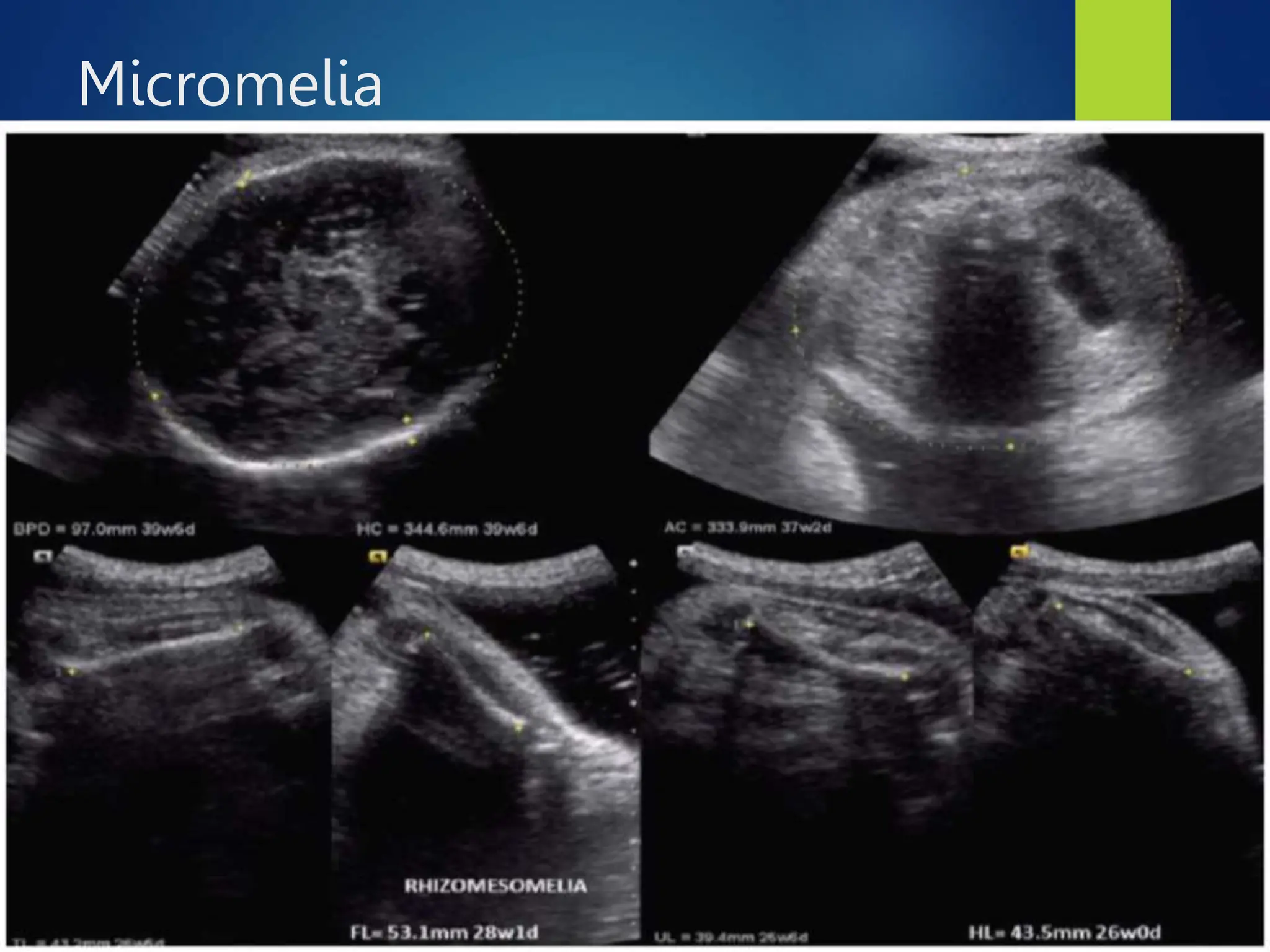 FETAL SKELETAL ANOMALIES GROUP 3.pptx