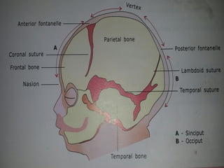 Sutures Of The Fetal Skull