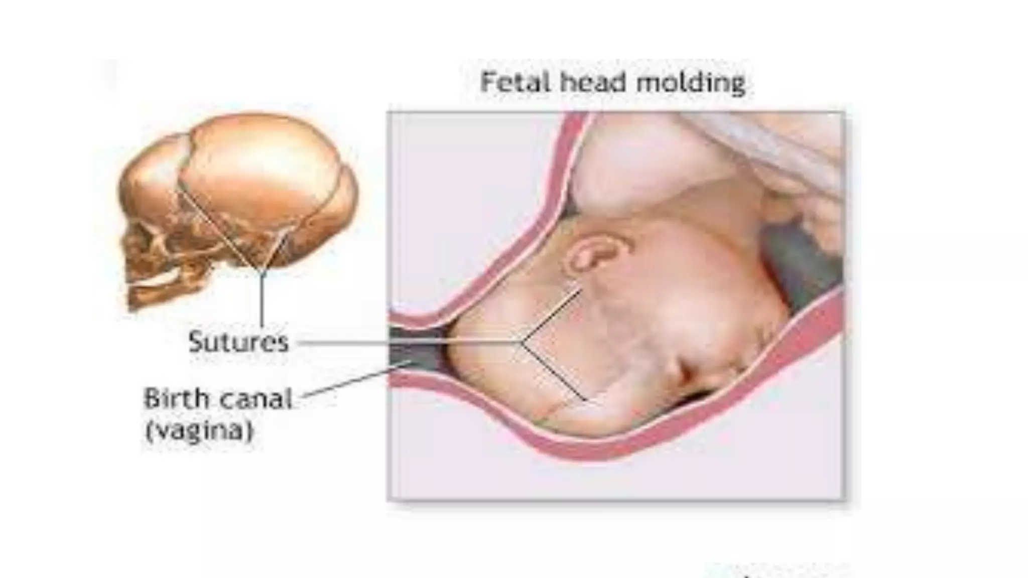 Fetal skull | PPTX