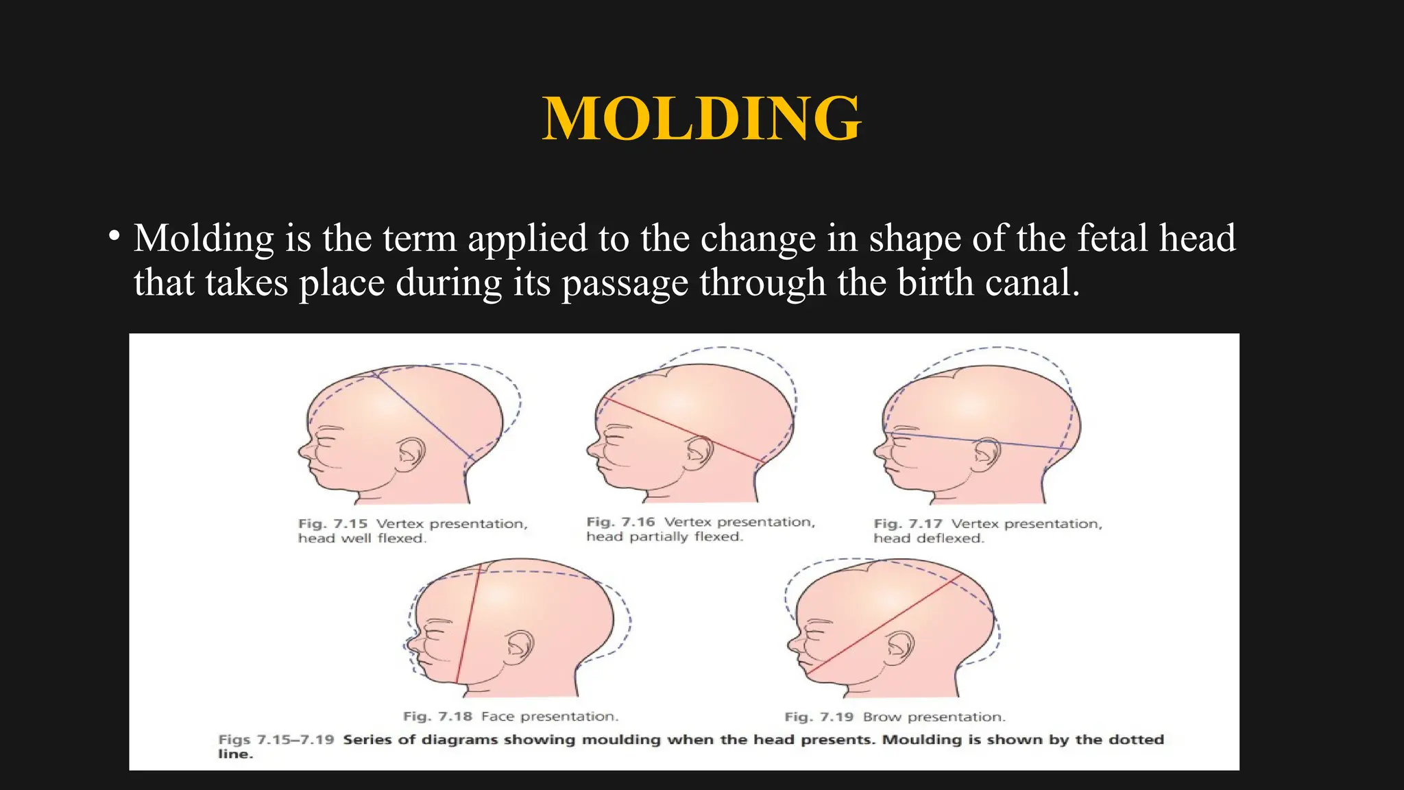 FETAL SKULL pptx by Rashmi Goswami (OBG) | PPTX