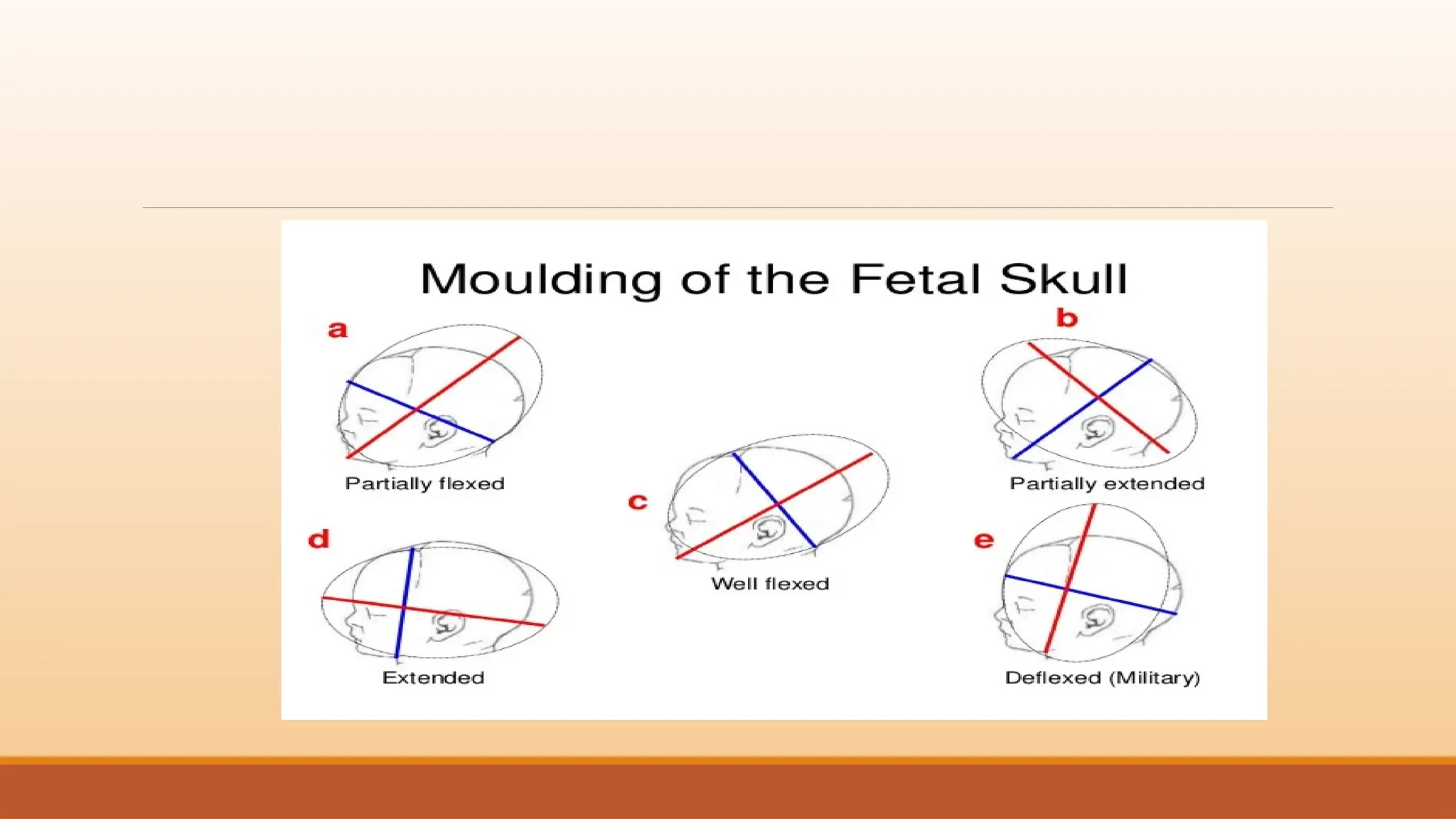 P.Fetal skull. Introduction,Region and landmark of fetal skull,bone in ...