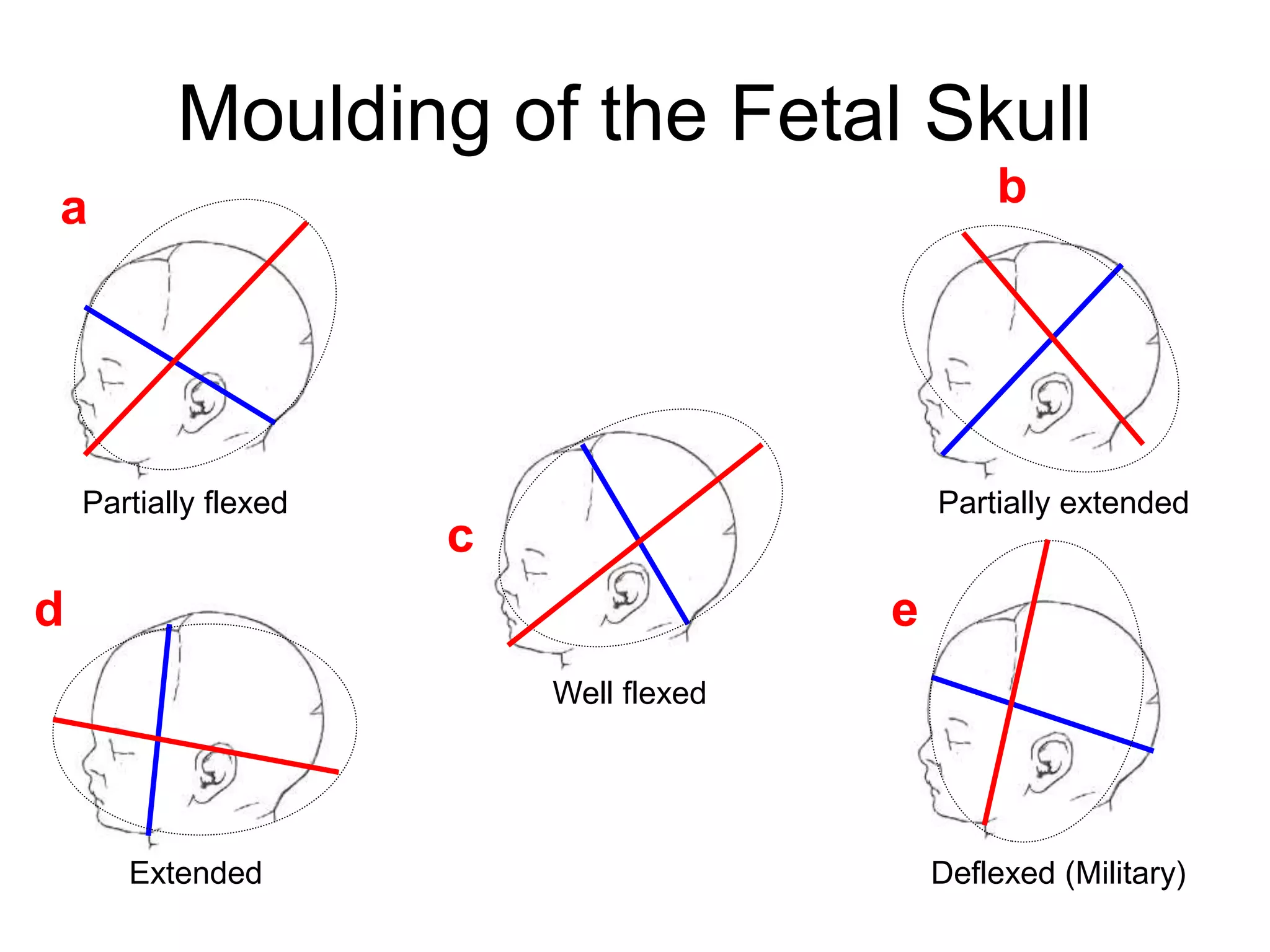 Fetal skull | PPT