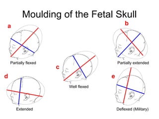 Fetal skull | PPT
