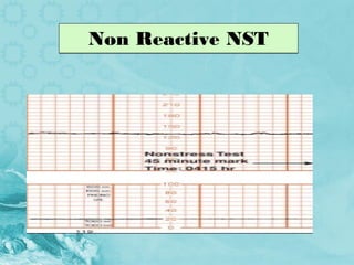 Reactive Non Stress Test