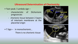 Fetal surveillance in twin pregnancy | PPTX