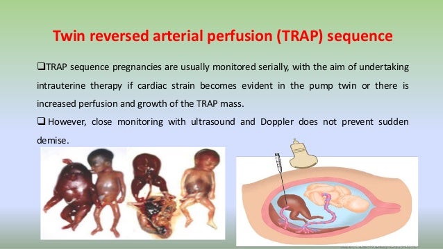 Fetal surveillance in twin pregnancy