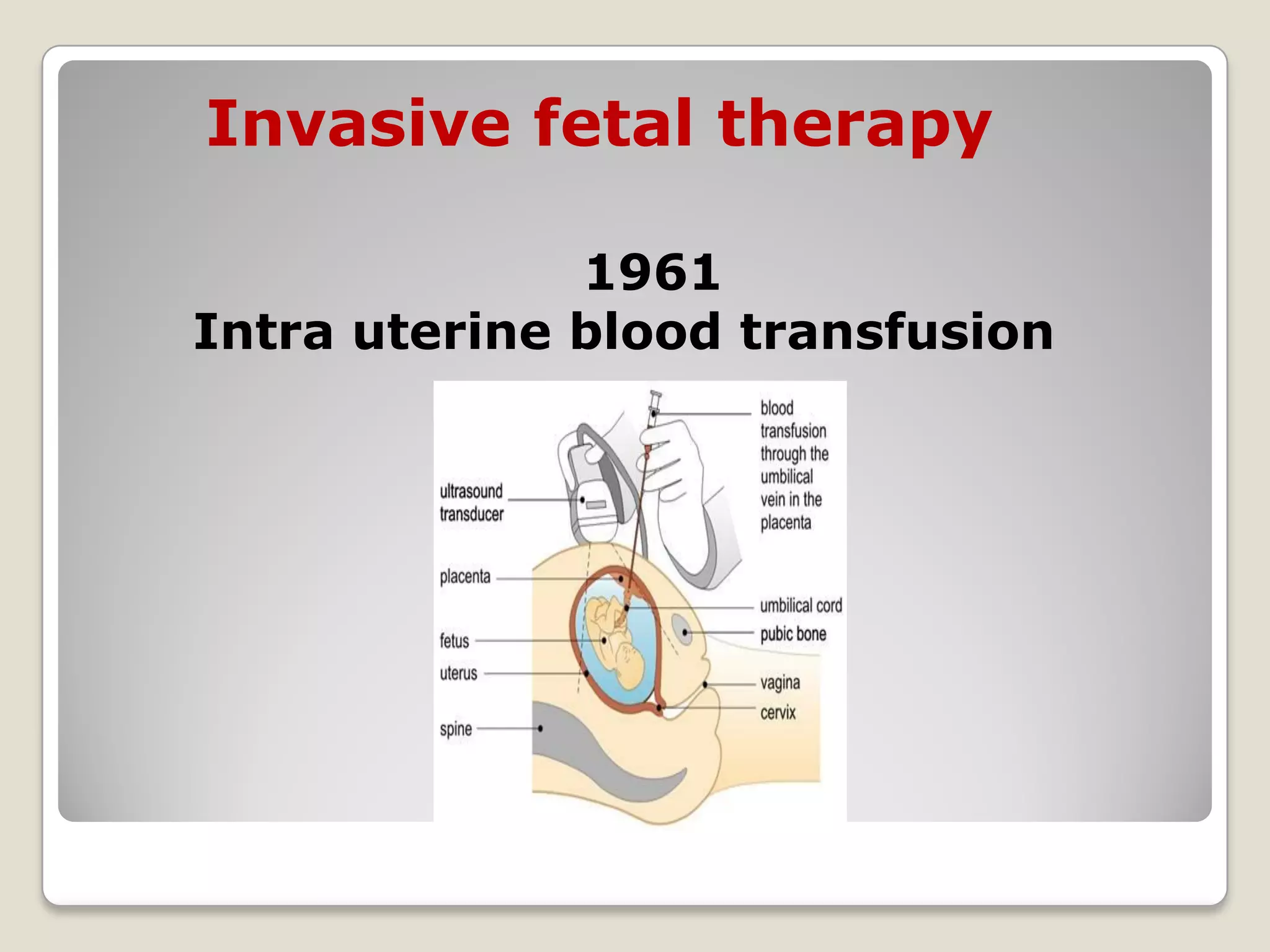 Fetal therapy | PDF