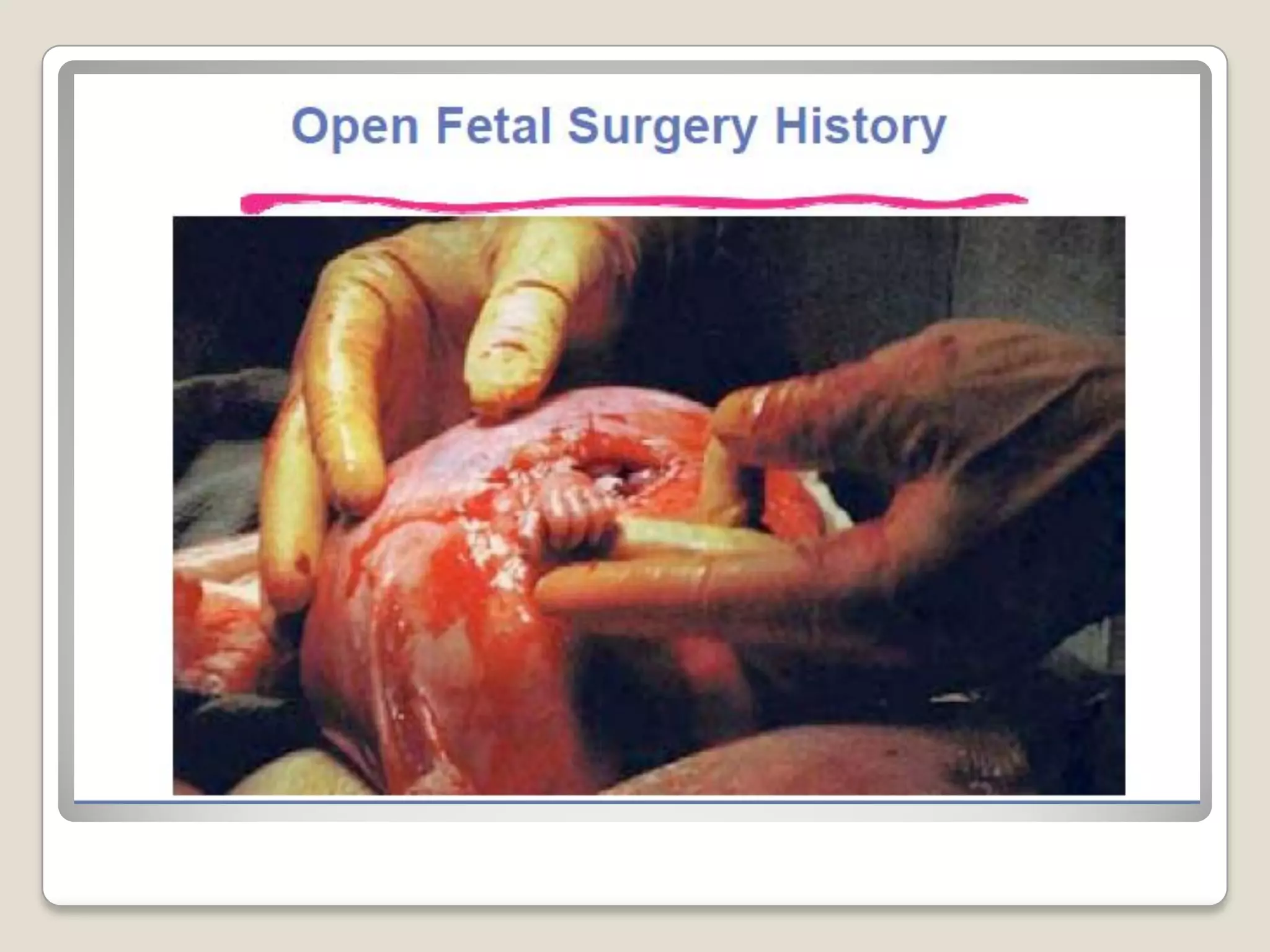 Fetal therapy | PDF