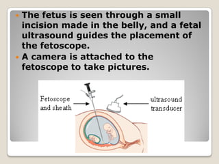 Fetal therapy | PDF