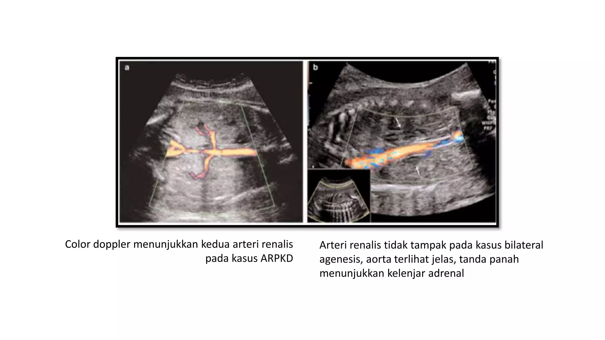 Fetal urinary tract ultrasound | PPTX