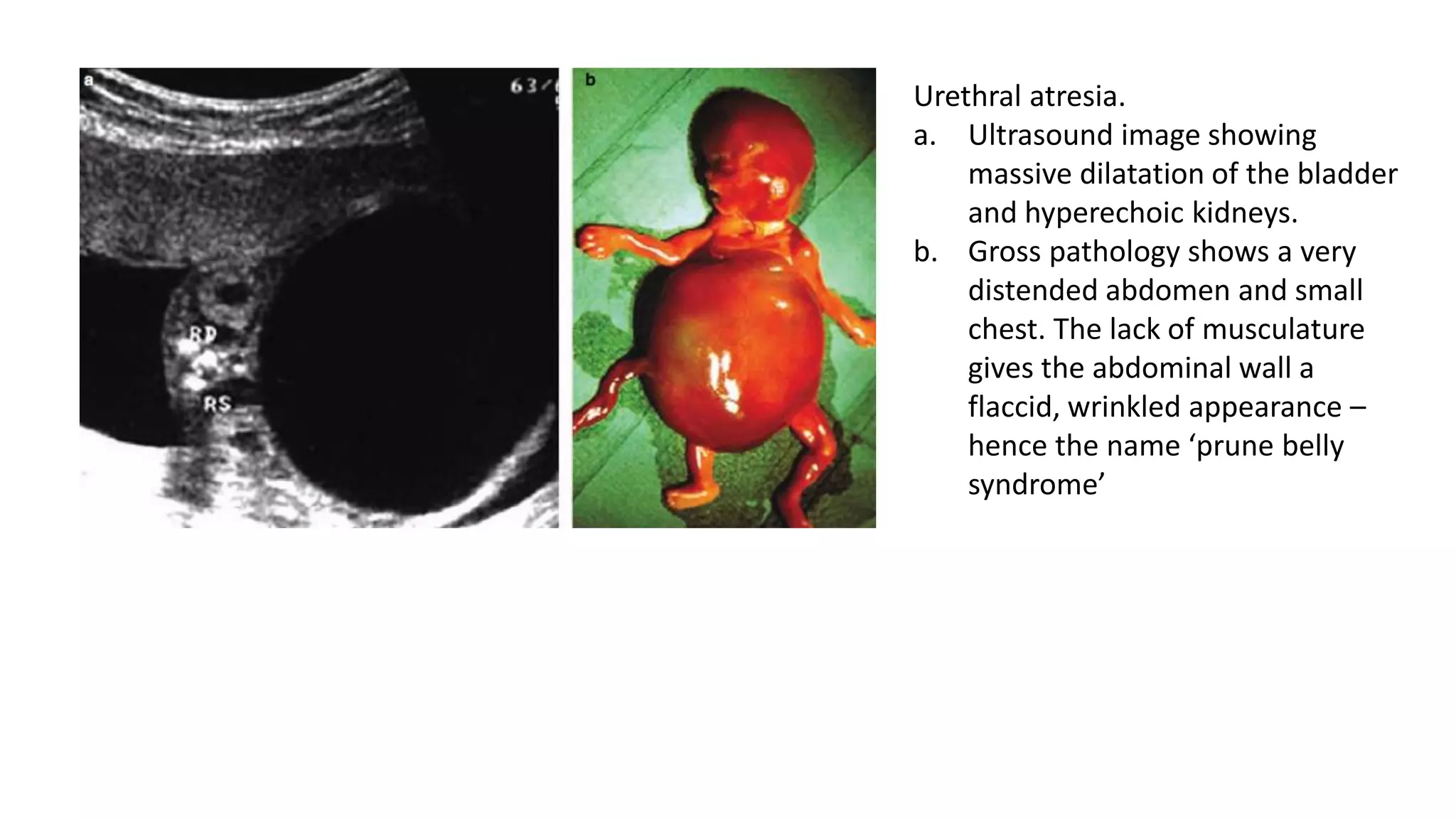 Fetal urinary tract ultrasound | PPTX