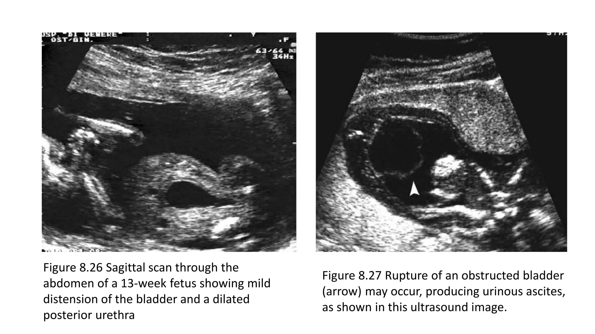 Fetal urinary tract ultrasound | PPTX