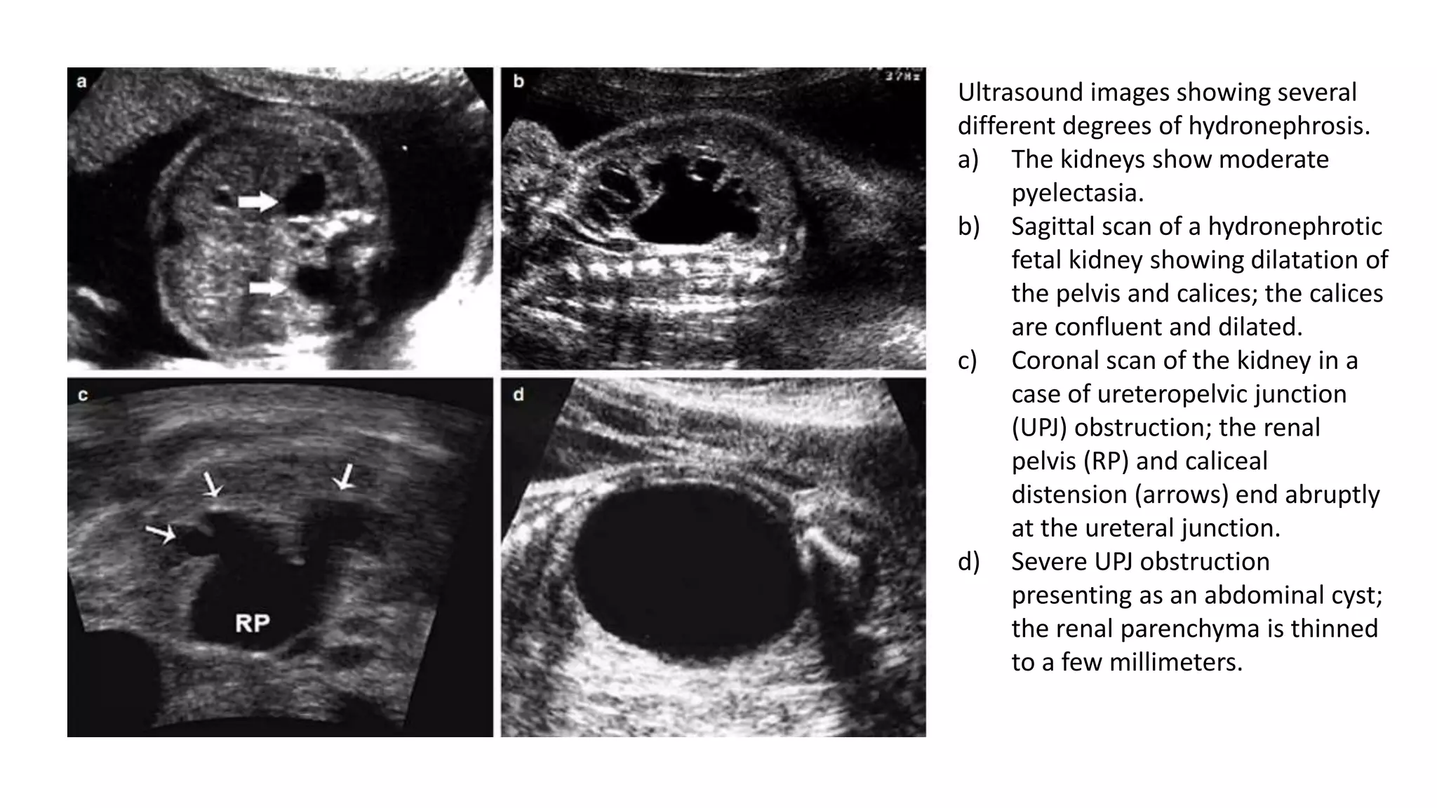 Fetal urinary tract ultrasound | PPTX