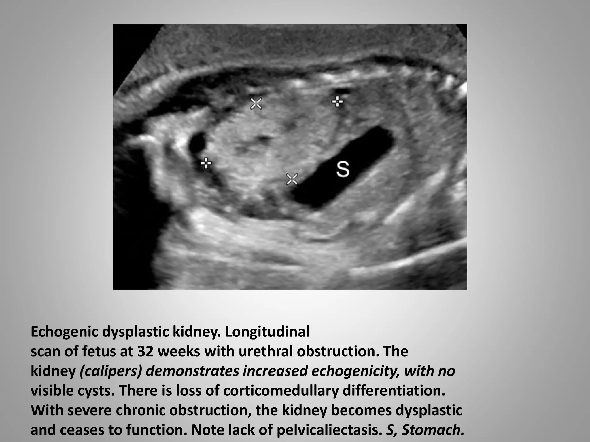 Fetal urogenital usg | PPTX
