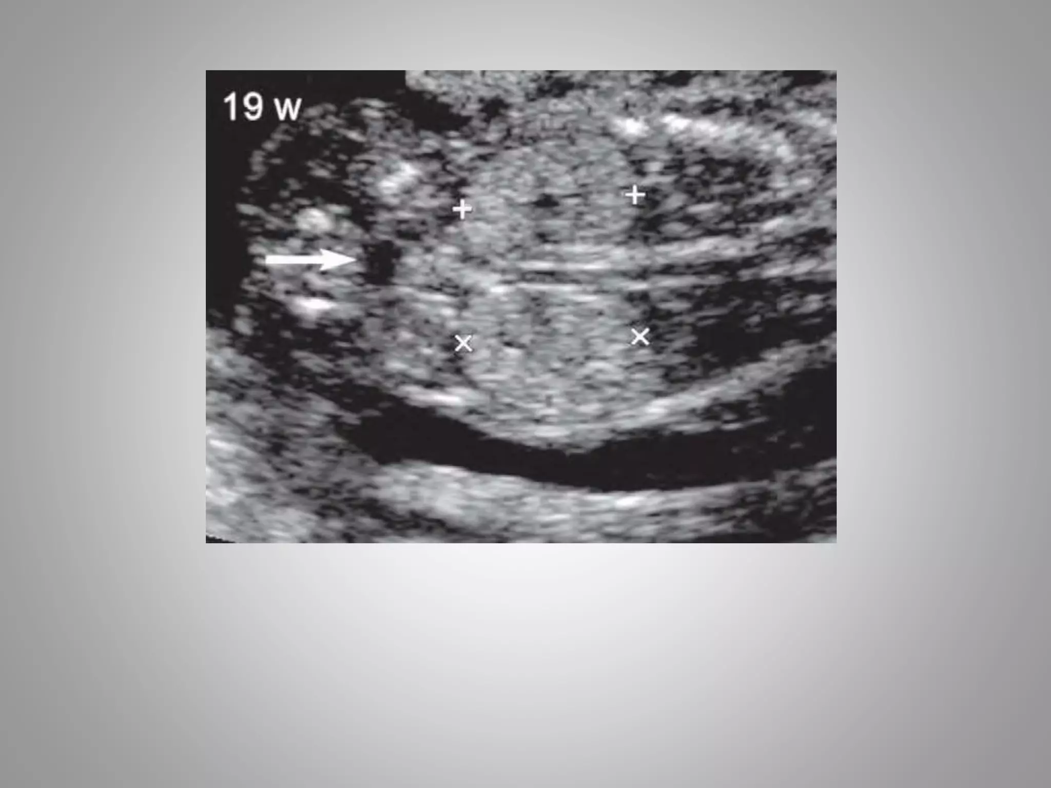 Fetal urogenital usg | PPTX