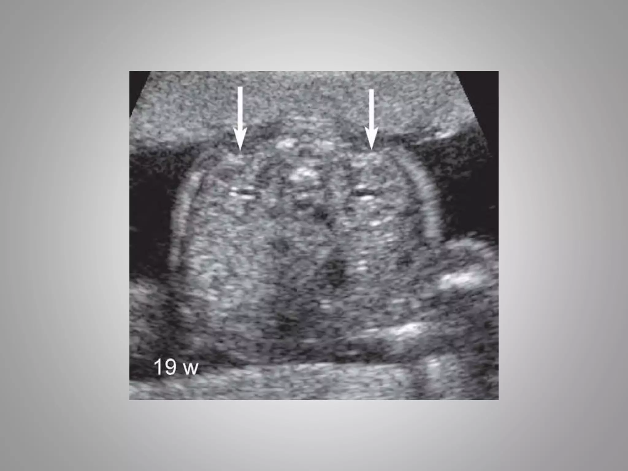 Fetal urogenital usg | PPTX