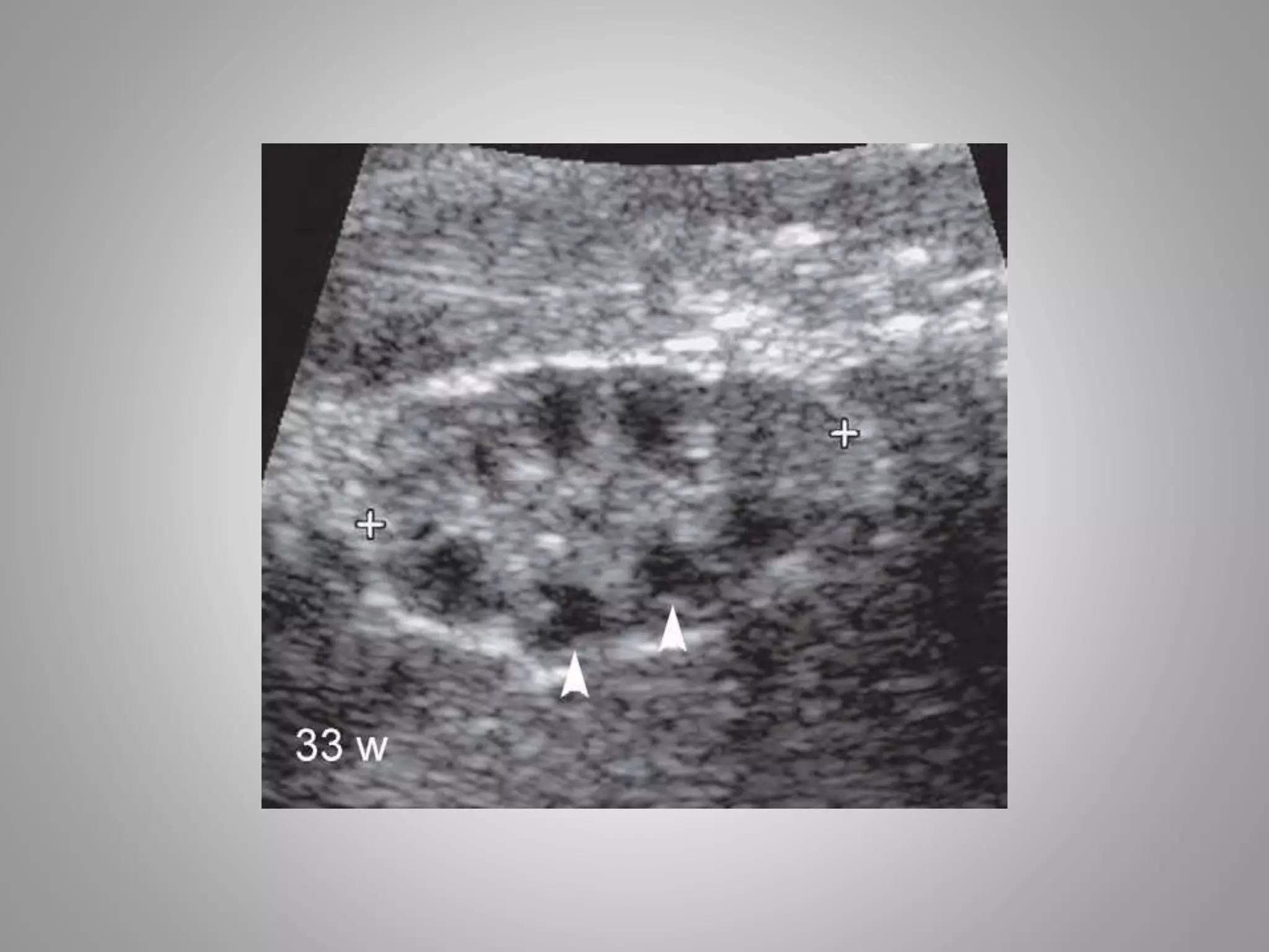 Fetal urogenital usg | PPTX