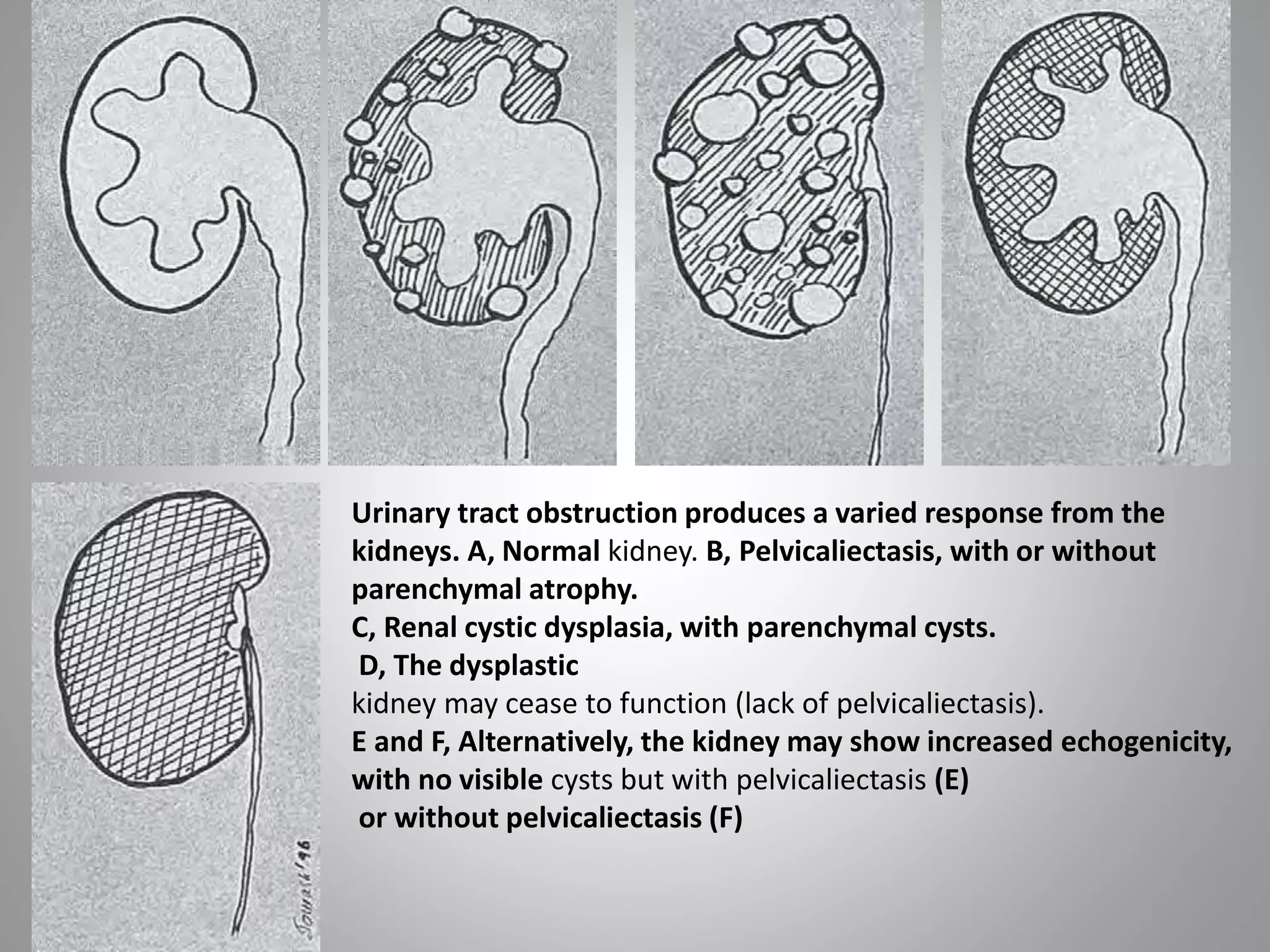 Fetal urogenital usg | PPTX