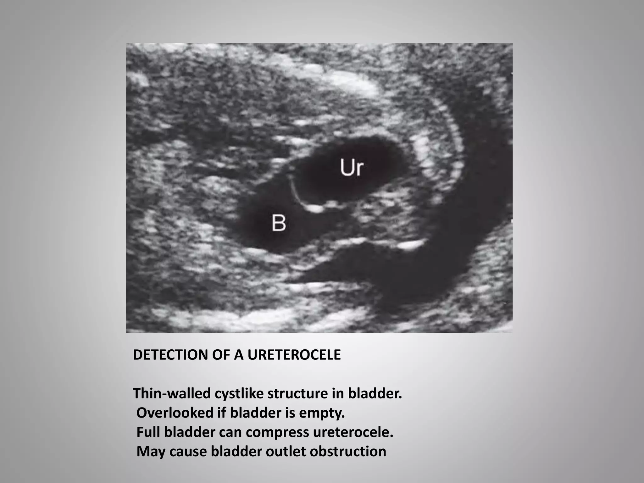 Fetal urogenital usg | PPTX