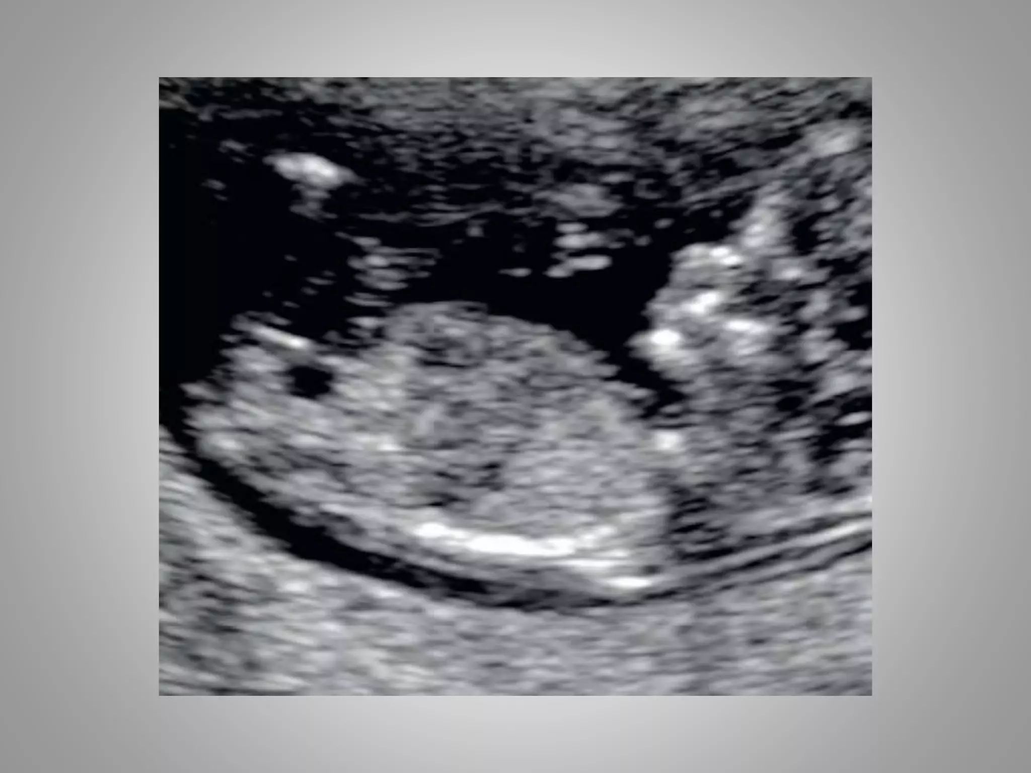 Fetal urogenital usg | PPTX