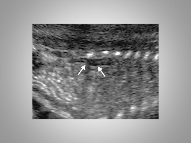 Fetal urogenital usg | PPTX