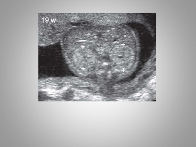 Fetal urogenital usg | PPTX