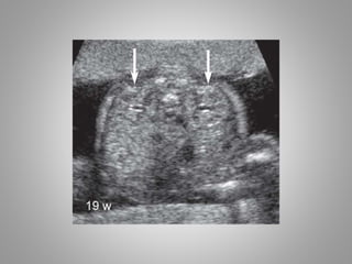 Fetal urogenital usg | PPTX