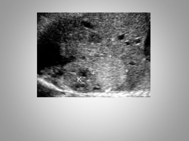 Fetal urogenital usg | PPTX