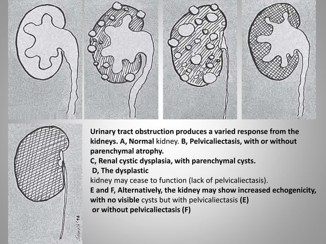 Fetal urogenital usg | PPTX
