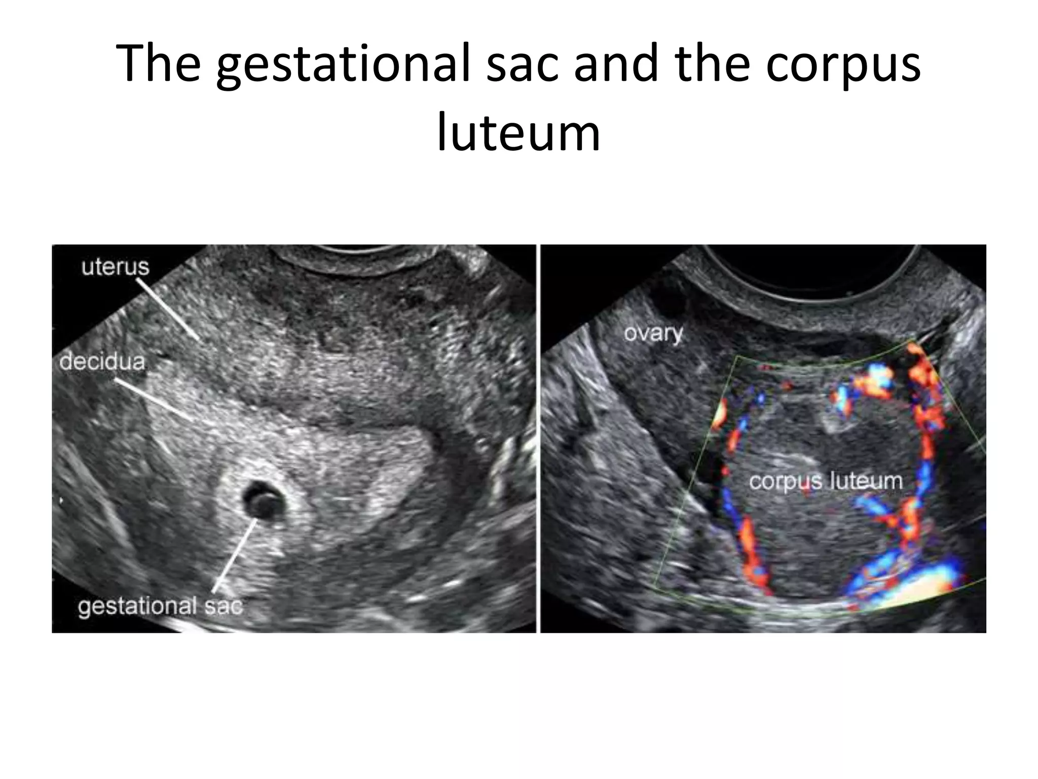 Fetal usg | PPTX