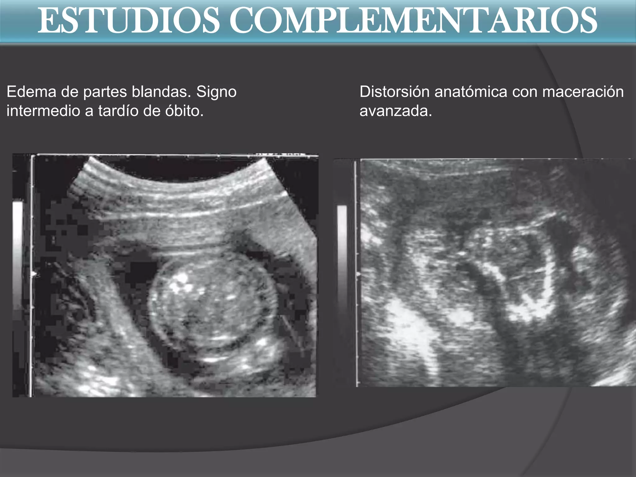 Feto muerto ppt | PPT