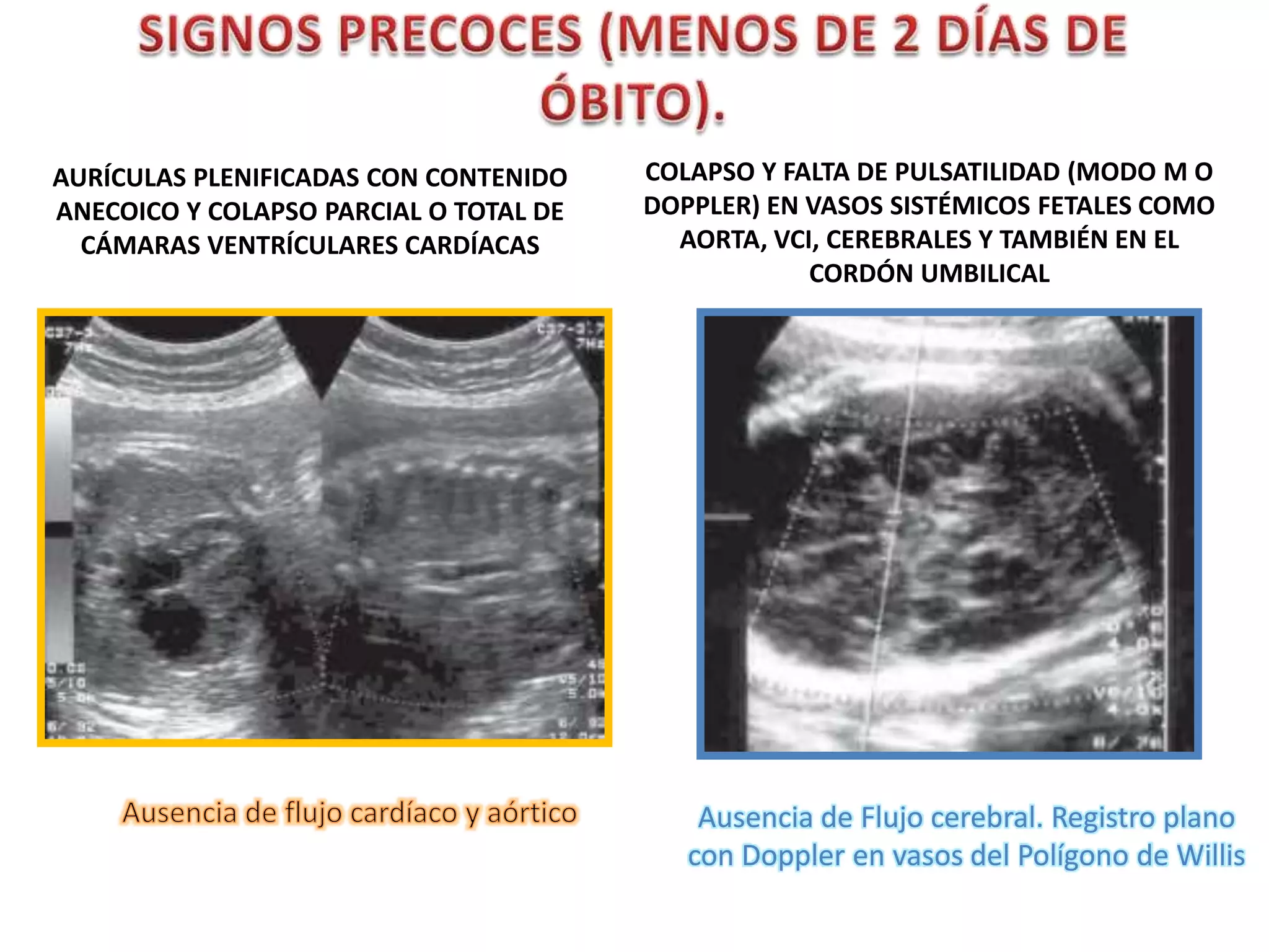 Feto muerto ppt | PPTX | Pregnancy | Reproductive Health