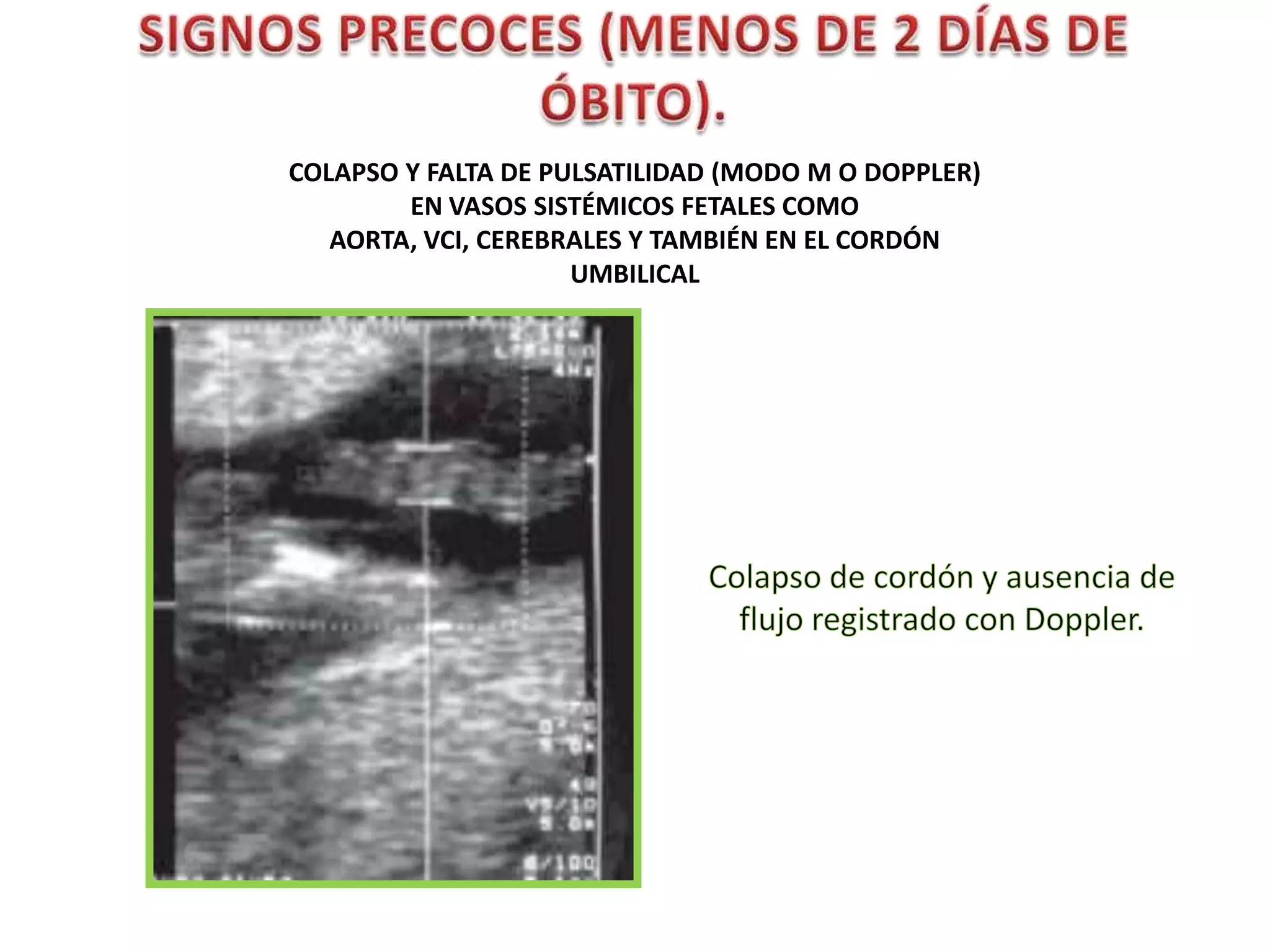 Feto muerto ppt | PPTX | Pregnancy | Reproductive Health