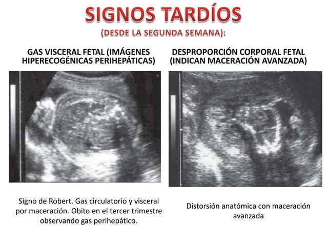 Feto muerto ppt | PPTX | Pregnancy | Reproductive Health