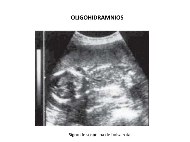 Feto muerto ppt | PPTX | Pregnancy | Reproductive Health