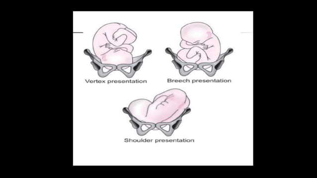 Fetopelvic relationship final presentation.pptx | Pregnancy ...