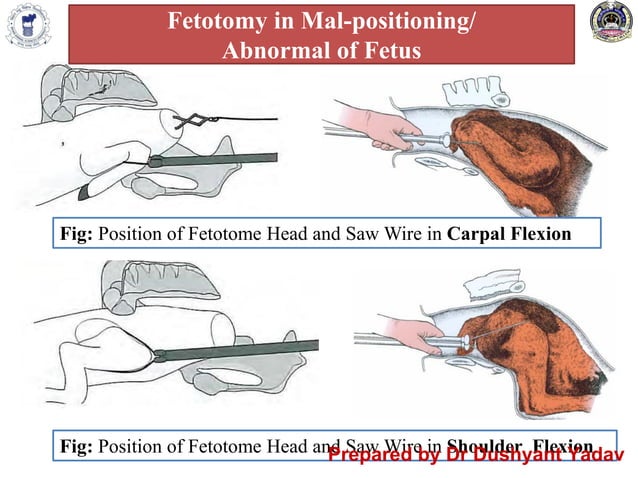 Fetotomy in bovines by Dr Dushyant Yadav BASU, Patna INDIA | PDF ...