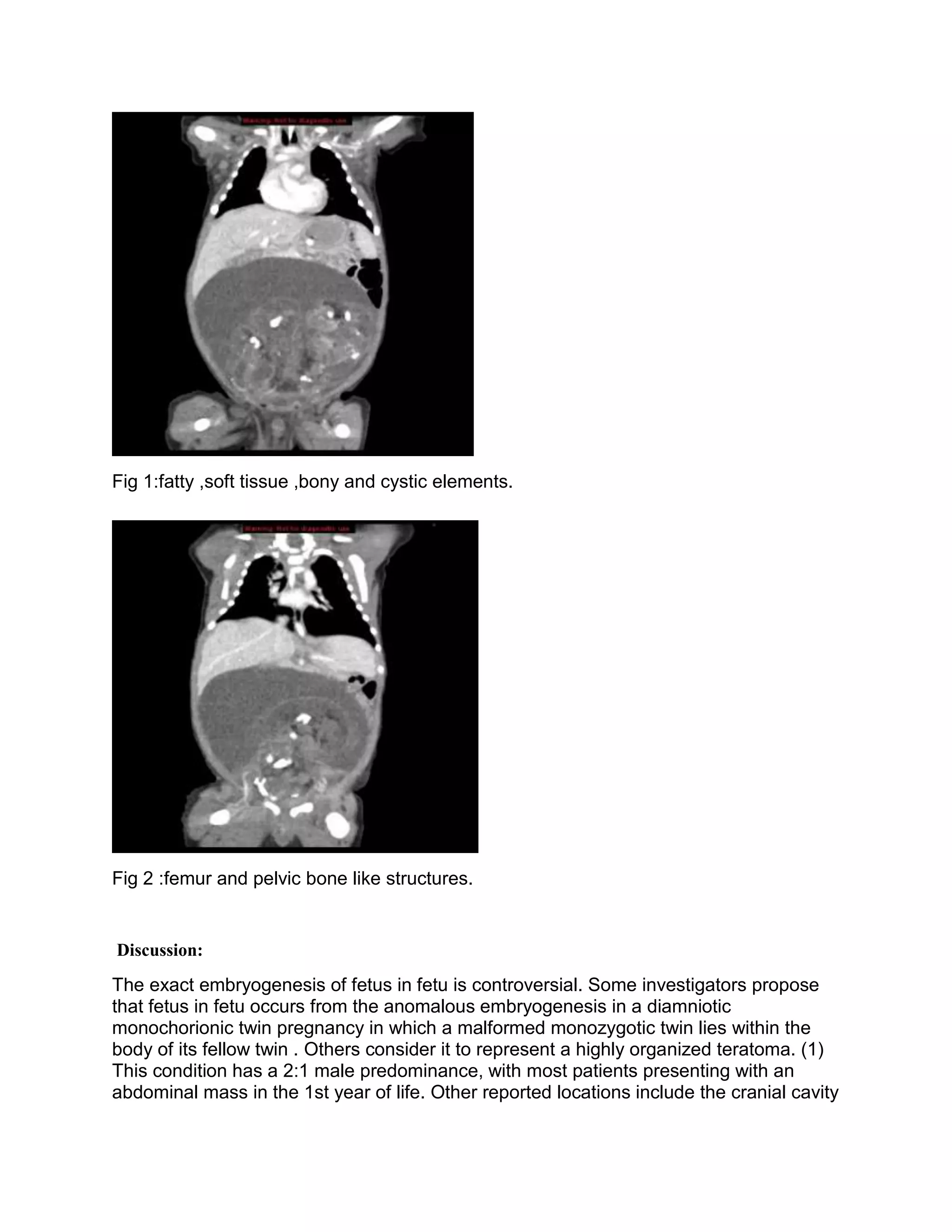 Fetus in fetu computed tomographic findings. | DOCX