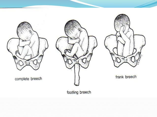 Fetus in utero | PPTX
