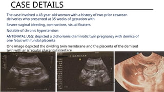 Sudden loss of fetal heart tones, shock, and collapse if rupture is ...