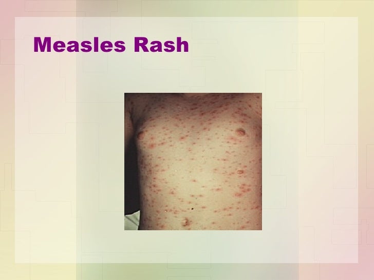 Fever And Rash