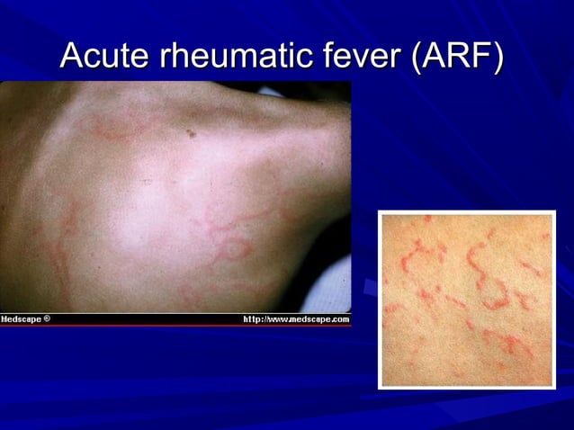 Fever and rash