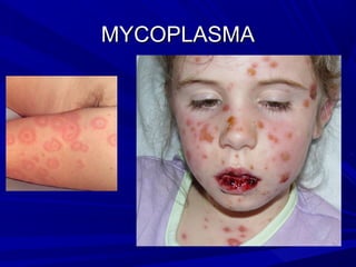 Mycoplasma Rash