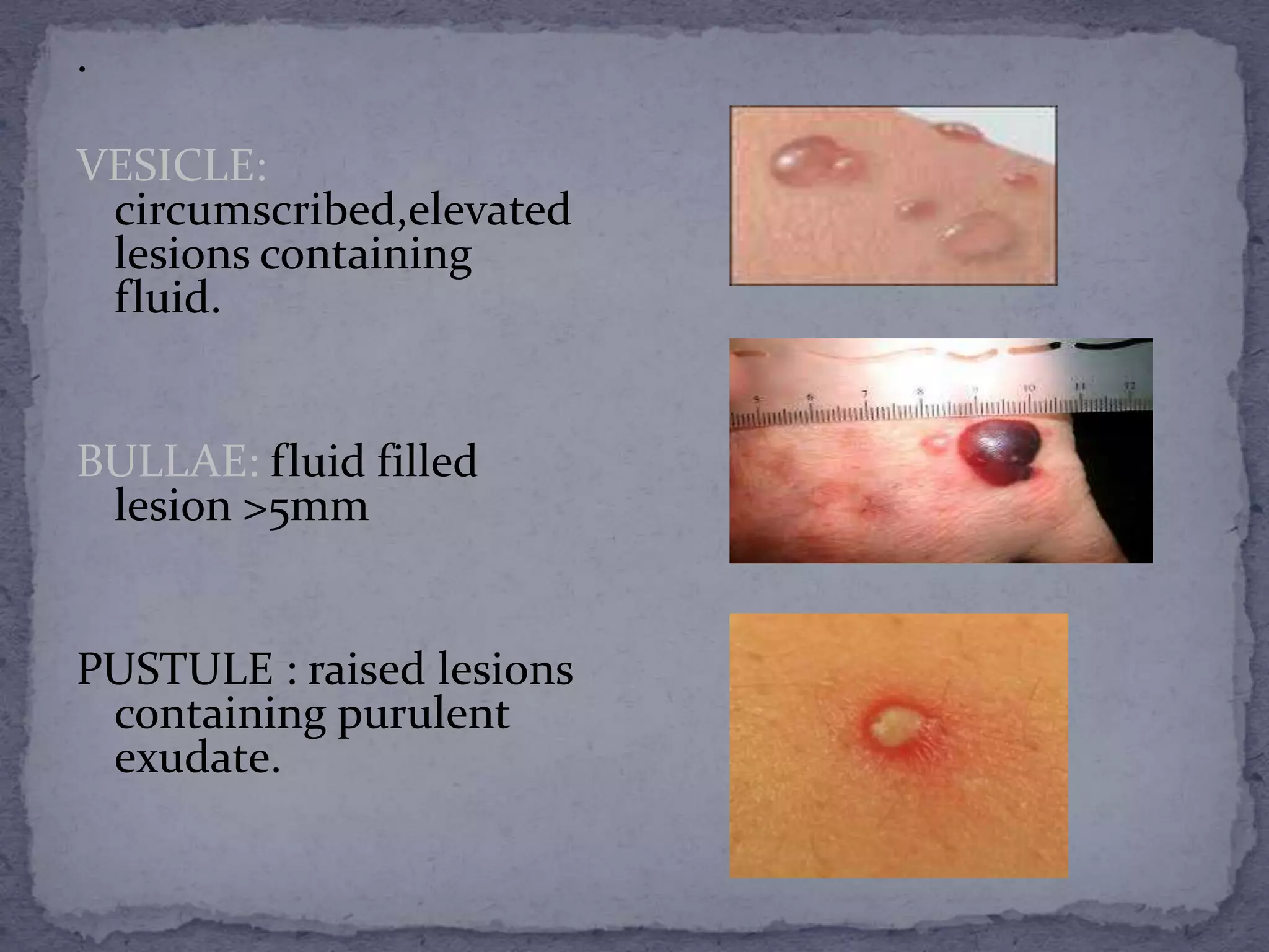 Fever and rash | PPTX