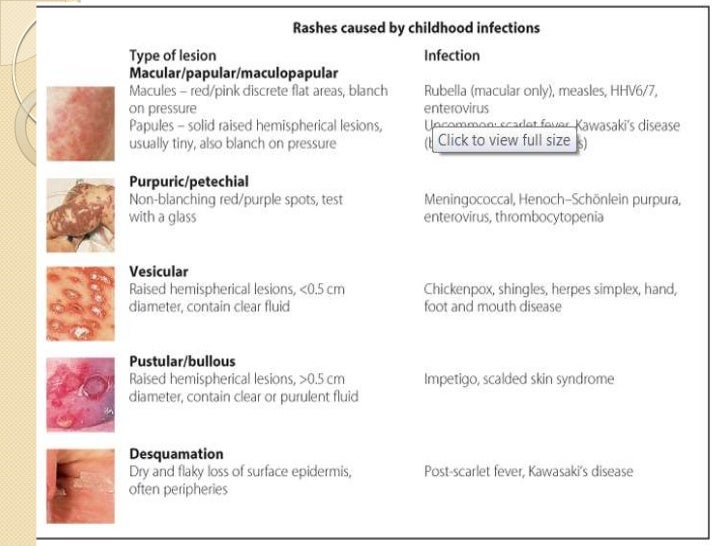 Fever and rash by Dr.Uma