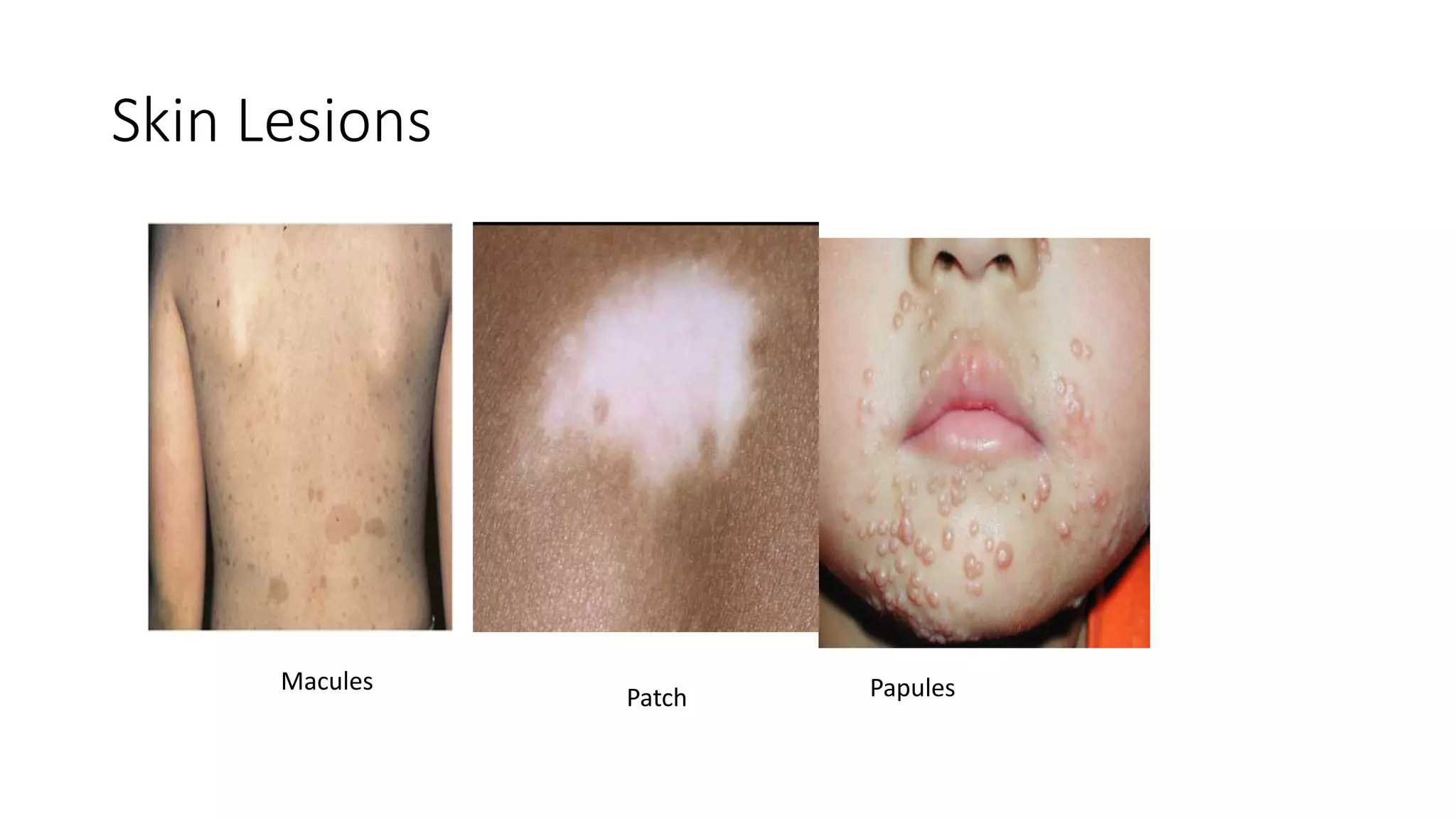 fever and rashes.pptx | Skin and Dermatology | Diseases and Conditions