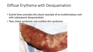 fever and rashes.pptx